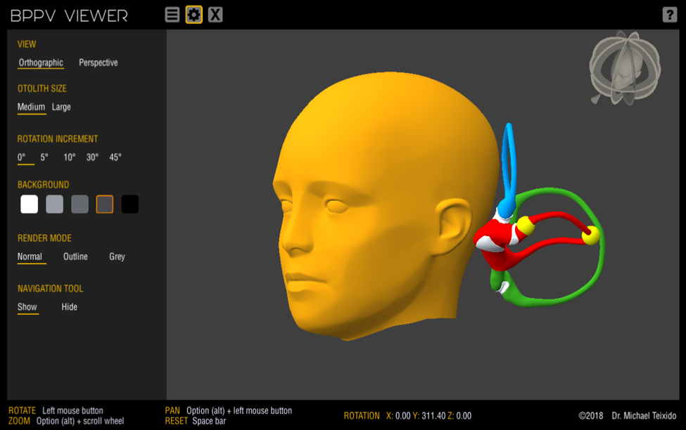 BPPV Viewer – BPPV Visualization with a 3D Model for Study and Teaching ...