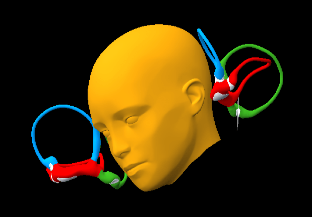 Cupulolithiasis – BPPV Viewer