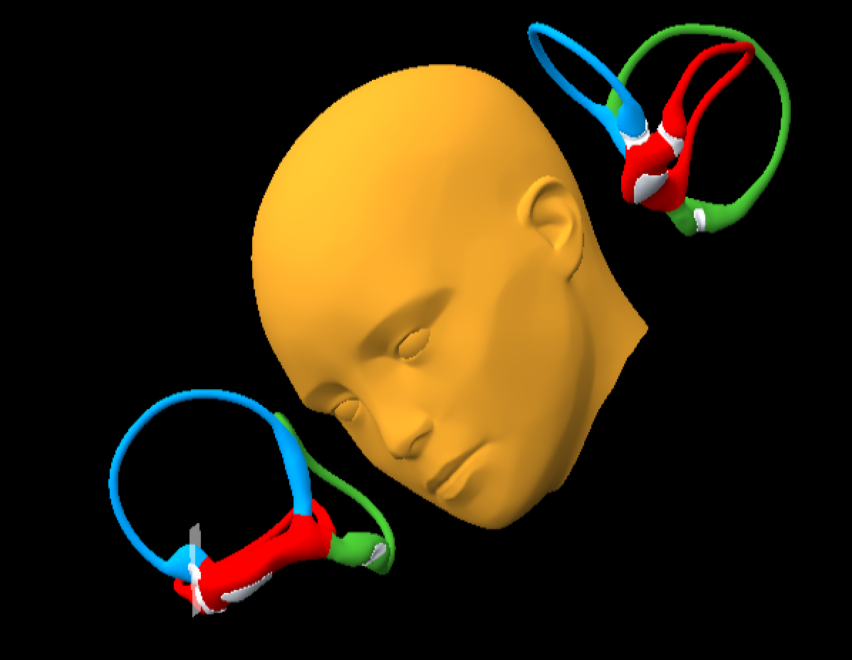 Cupulolithiasis – BPPV Viewer