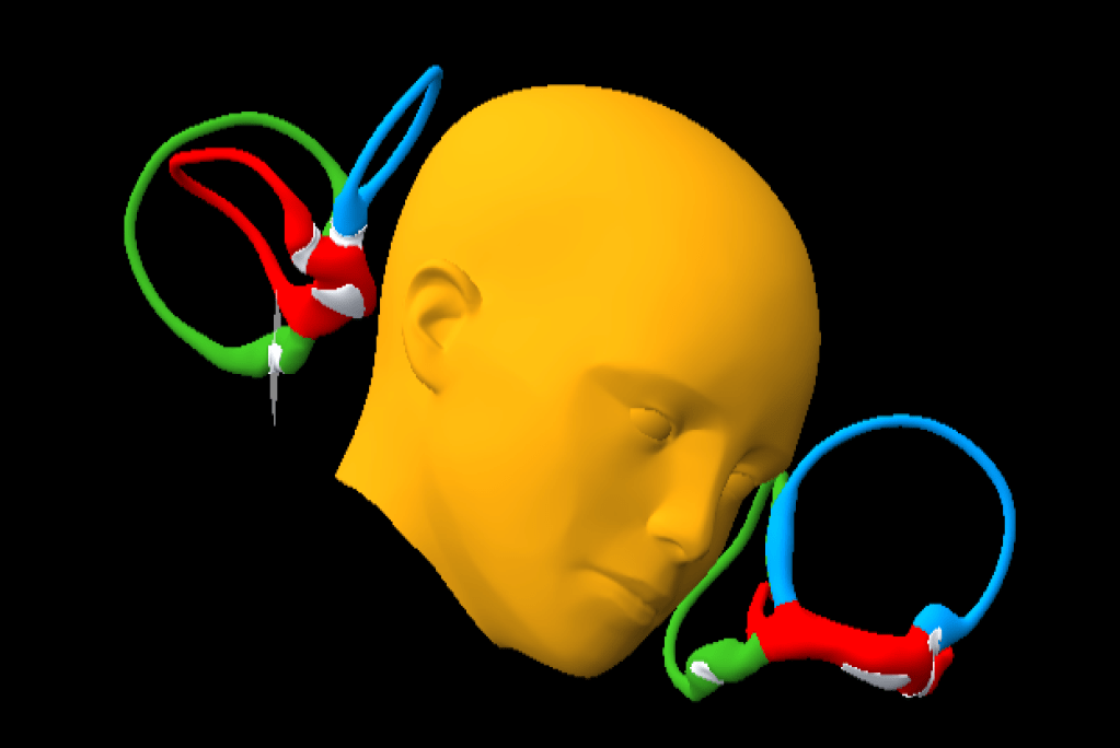 Cupulolithiasis – BPPV Viewer