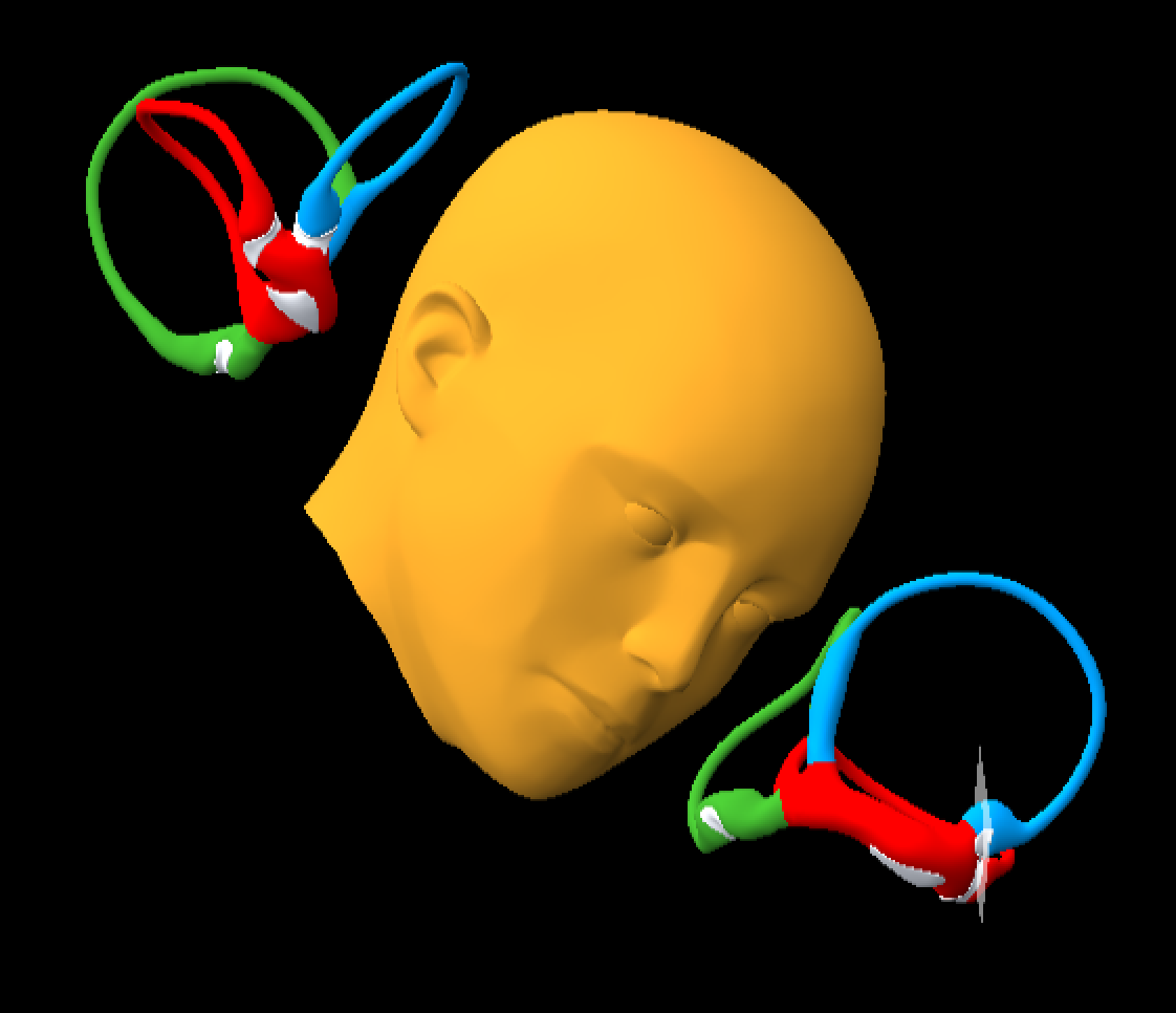 Cupulolithiasis – BPPV Viewer