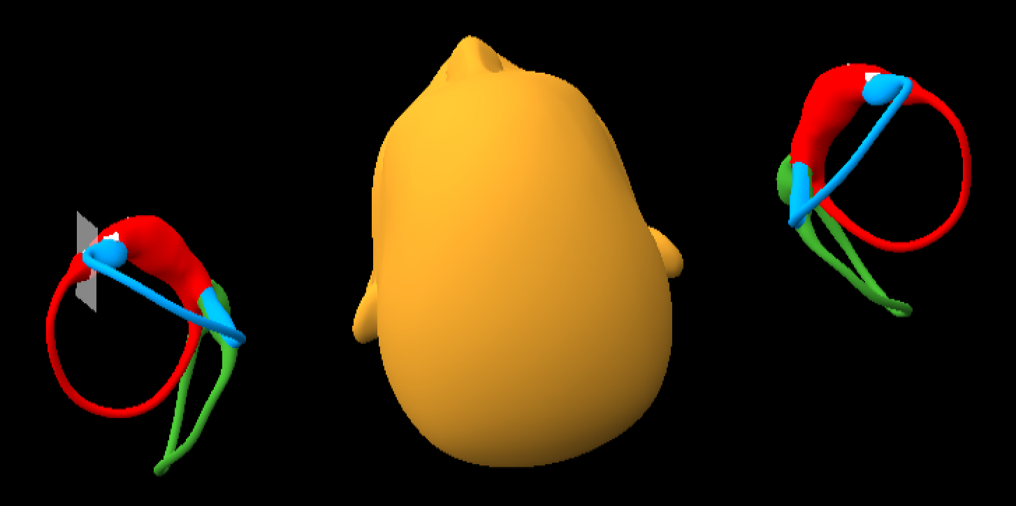 Cupulolithiasis – BPPV Viewer